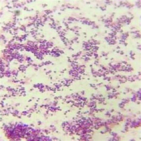 Antibiotic Sensitivity Patterns Of Anaerococcus Prevotii Isolated From