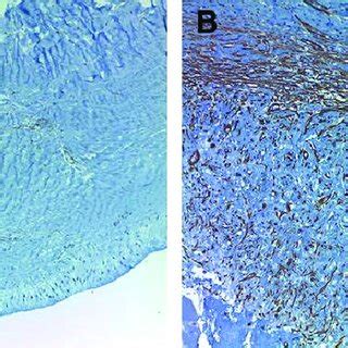 Histopathologic Evaluation Of Specimens ADM A And Native Breast