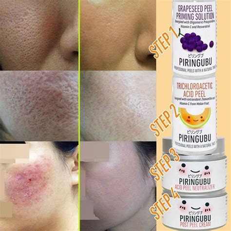 Piringubu Trichloroacetic Acid Tca Peel Set♧ Lazada Ph