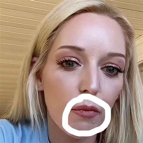 What Is That Bump On Her Lip It Dont Look Right Aside From Her Very