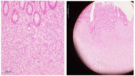 Hereditary Diffuse Gastric Cancer Updated Clinical Guidelines With An