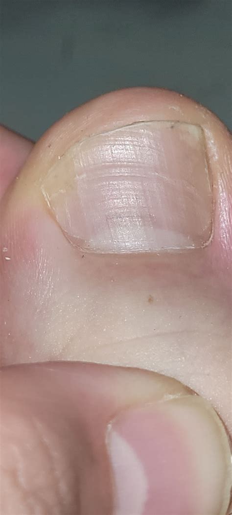 잘못 깎으면내성발톱이 생길까요 지식in