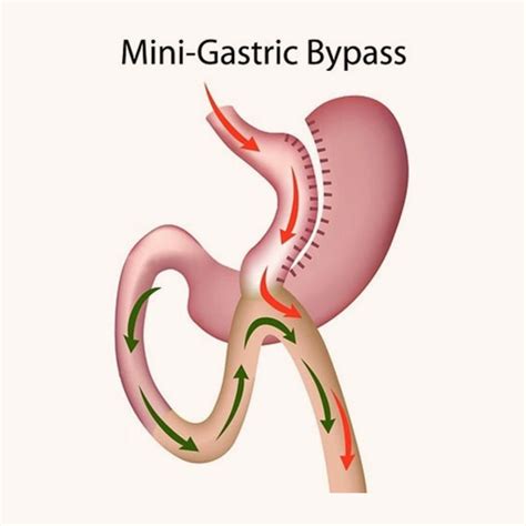 Learn About The Mini Gastric Bypass Surgery Anshobecure