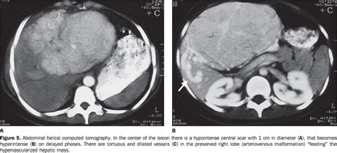 Hiperplasia Nodular Focal Hiperplasia Focal Nodular