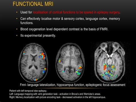 Mesial Temporal Lobe Epilepsy
