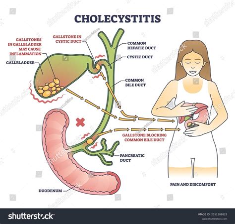 Cholecystitis Gallbladder Inflammation Blocked Gallbladder Outline Stock Vector Royalty Free