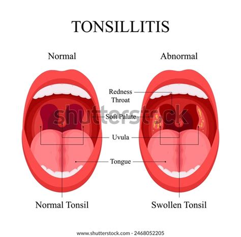 Diagramme Des Causes De Tonsillitis Tonsils Image Vectorielle De Stock Libre De Droits