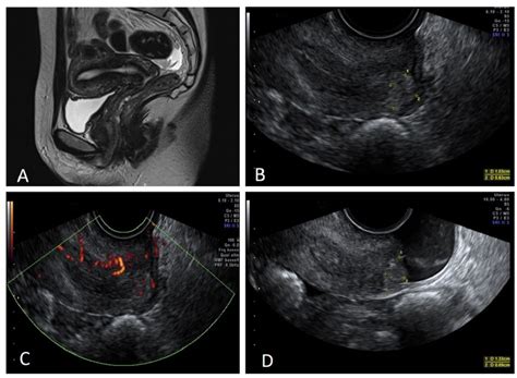 Small Tumor After Conization A Not Detectable Disease By MRI B