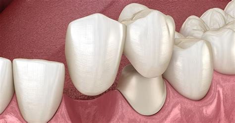 Cantilever Bridges Dental Office Network Search Find And Review