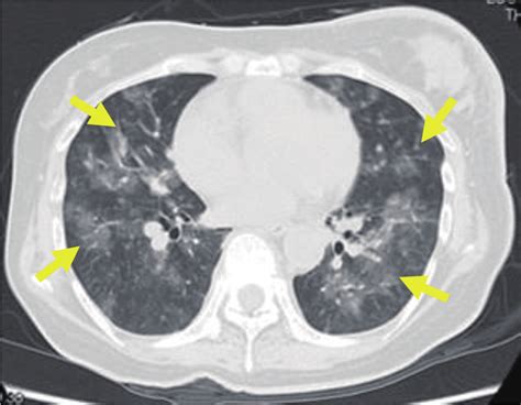Computed Tomography Scan Showing Multiple Infiltrations In Both Lungs Download Scientific