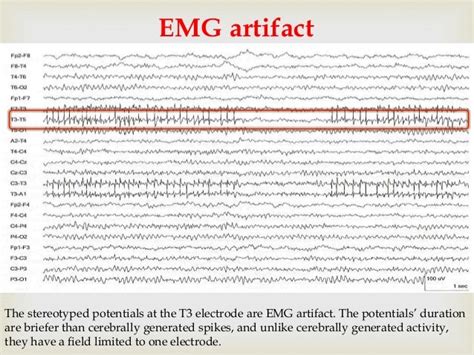 Eeg Artifacts