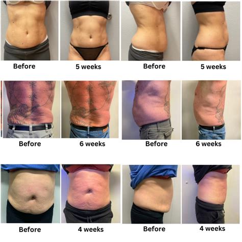 Vampire Breast Lift A Non Surgical Alternative To Enhance Breast