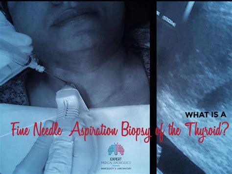 Thyroid Biopsy Is Used To Expert Medical Diagnostics