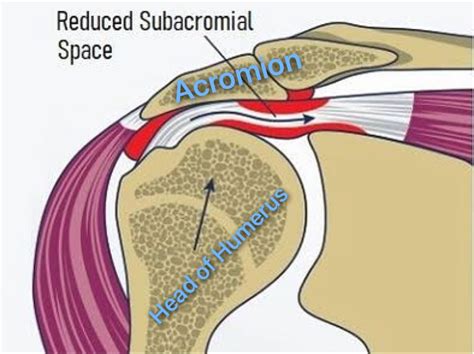 Dr Zakria Al Mahmoud On Linkedin Shoulder Impingement Syndrome