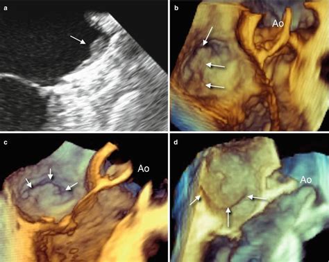 Percutaneous Closure Of The Left Atrial Appendage Radiology Key