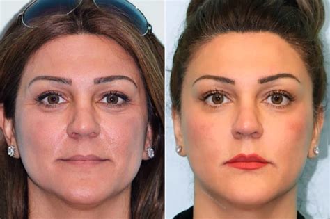 Juvederm Voluma Xc Virginia Washington Dc And Maryland