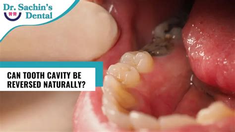 Can Tooth Cavity Be Reversed Naturally Shocking Revelation