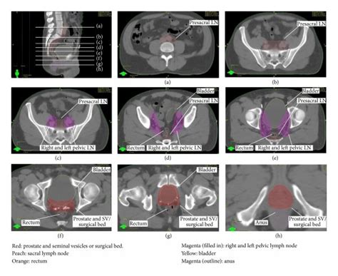 CT Simulation Scan Demonstrating Contoured Volumes Download Scientific Diagram