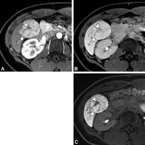 Focal Nodular Hyperplasia Central Scar