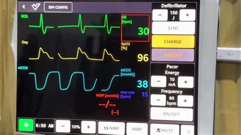Accelerated Ventricular Rhythm Youtube