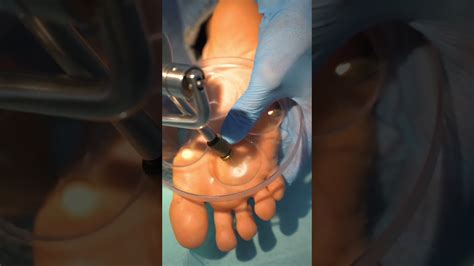 5 лучших видов удаления бородавок как избавиться от чего появляются как вывести