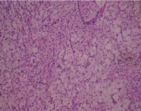 Figure 2 From Steroid Cell Tumor Of Ovary A Case Report Semantic Scholar