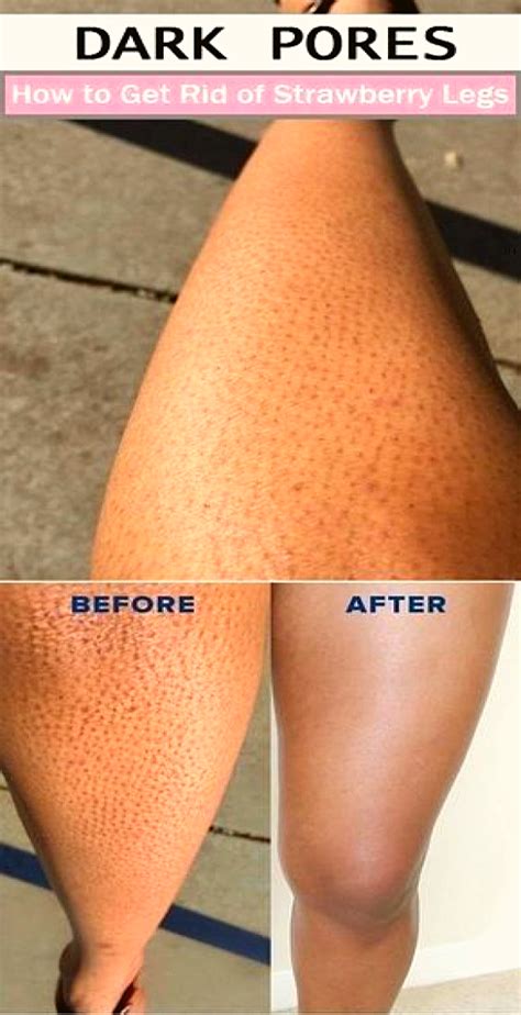 This Is How You Can Get Rid Of Dark Pores On Legs At Home Strawberry Legs Dark Pores