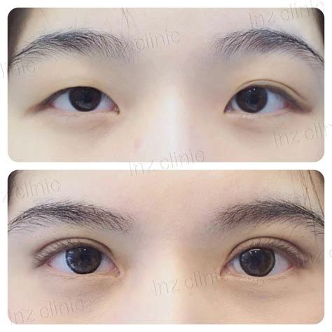 ปัญหาตาสองชั้นหลบใน แก้ไขยังไงให้สวยเป๊ะ Inz Clinic