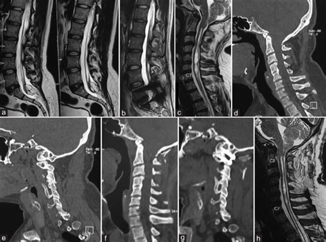 A T2 Weighted Magnetic Resonance Imaging Showing Tethered And