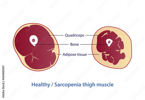 Infographic Of Healthy And Sarcopenia Thigh Muscle Vector Illustration