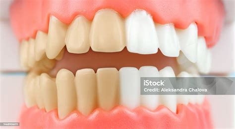 미백 전후에 깨끗하고 더러운 치아 치과 개념 사진입니다 클로즈업 개별 치아 트레이 교정 치과 테마 거울에 대한 스톡 사진 및