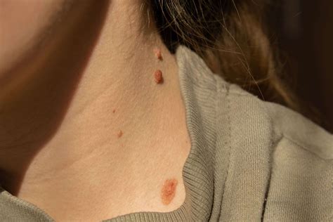 How Skin Tone Influences Skin Cancer Risk And Protection