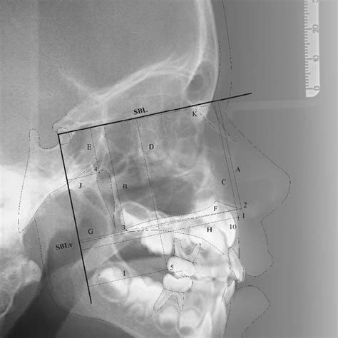 A The Palatal Plane Was Constructed With The Reference Of The Tips Of Download Scientific