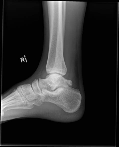 Posterior Talar Process Fracture Radiology Case