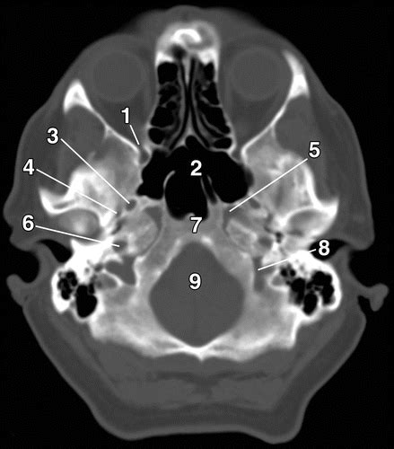 Cranial Bone Anatomy Ct Axial