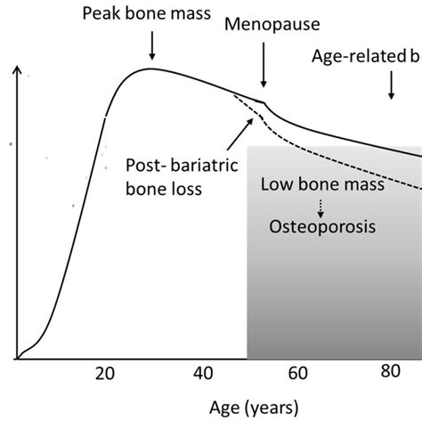 Age Related Loss Of Bone Mass In Women Schematic In Both Women And
