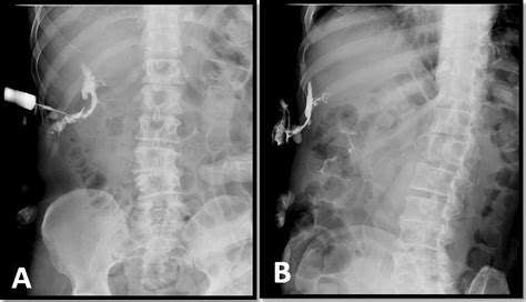 Spontaneous Cholecystocutaneous Fistula Secondary To