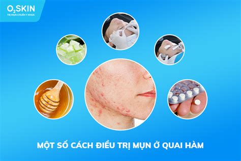 Hướng Dẫn Cách điều Trị Mụn ở Quai Hàm Hiệu Quả Phòng Khám O2 Skin