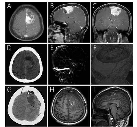 Figure 1 From Primary Intracranial Ewing Sarcoma Peripheral Primitive