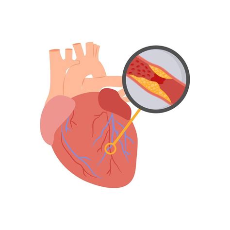 Myocardial Infarction Cardiovascular Disease Illustration Icon