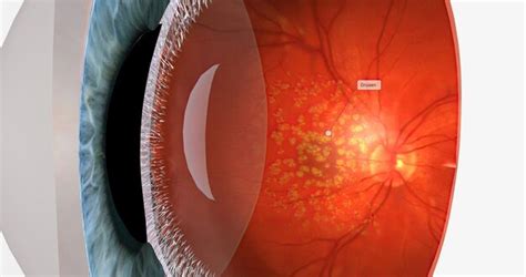 A degeneração macular seca é um tipo de deficiência visual relacionada