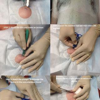 Reveal LinQ Insertion Technique Under Modified Method Group Download Scientific Diagram