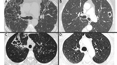 7 Diffuse Parenchymal Lung Disease Thoracic Key Parenchymal Lung