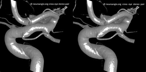 Superior Hypophyseal Artery
