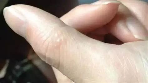 手上长小水疱？千万别挑破，用它擦一擦，止痒防复发！手掌