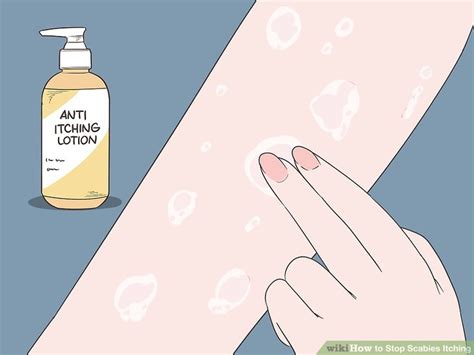 How To Stop Scabies Itching 11 Steps With Pictures Wikihow Health
