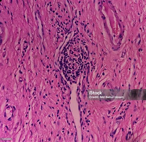 Cholelithiasis Of Gallbladder Microphotograph Of Chronic Cholecystitis
