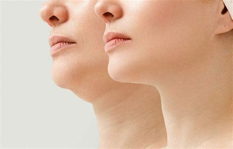 4 Causes Of Double Chin Discovery Health Journal Health And