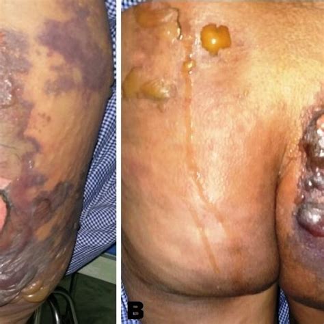 Well Defined Violaceous Patch With Reticulate Pigmentation And A Small