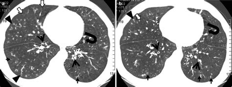 Decreased Opacity Without Cystic Walls Radiology Key